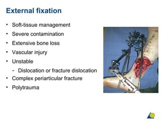 Open fractures | PPT
