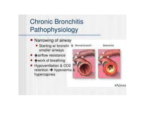 bronchitis - CHRONIC BRONCHITIS | PPTX