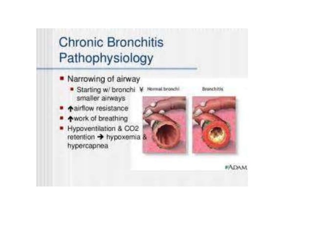 bronchitis - CHRONIC BRONCHITIS | PPT
