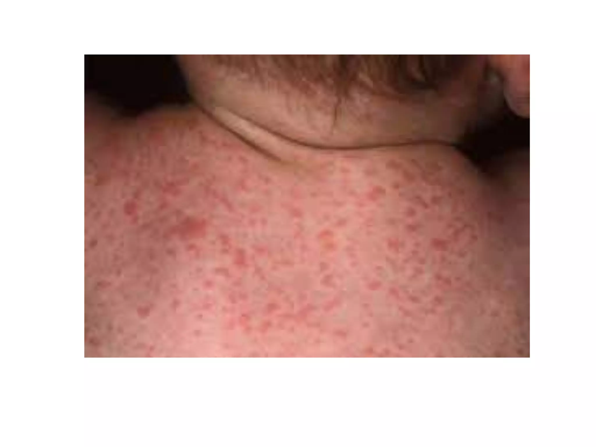 rashes - different types of rashes & diagnosis | PPTX