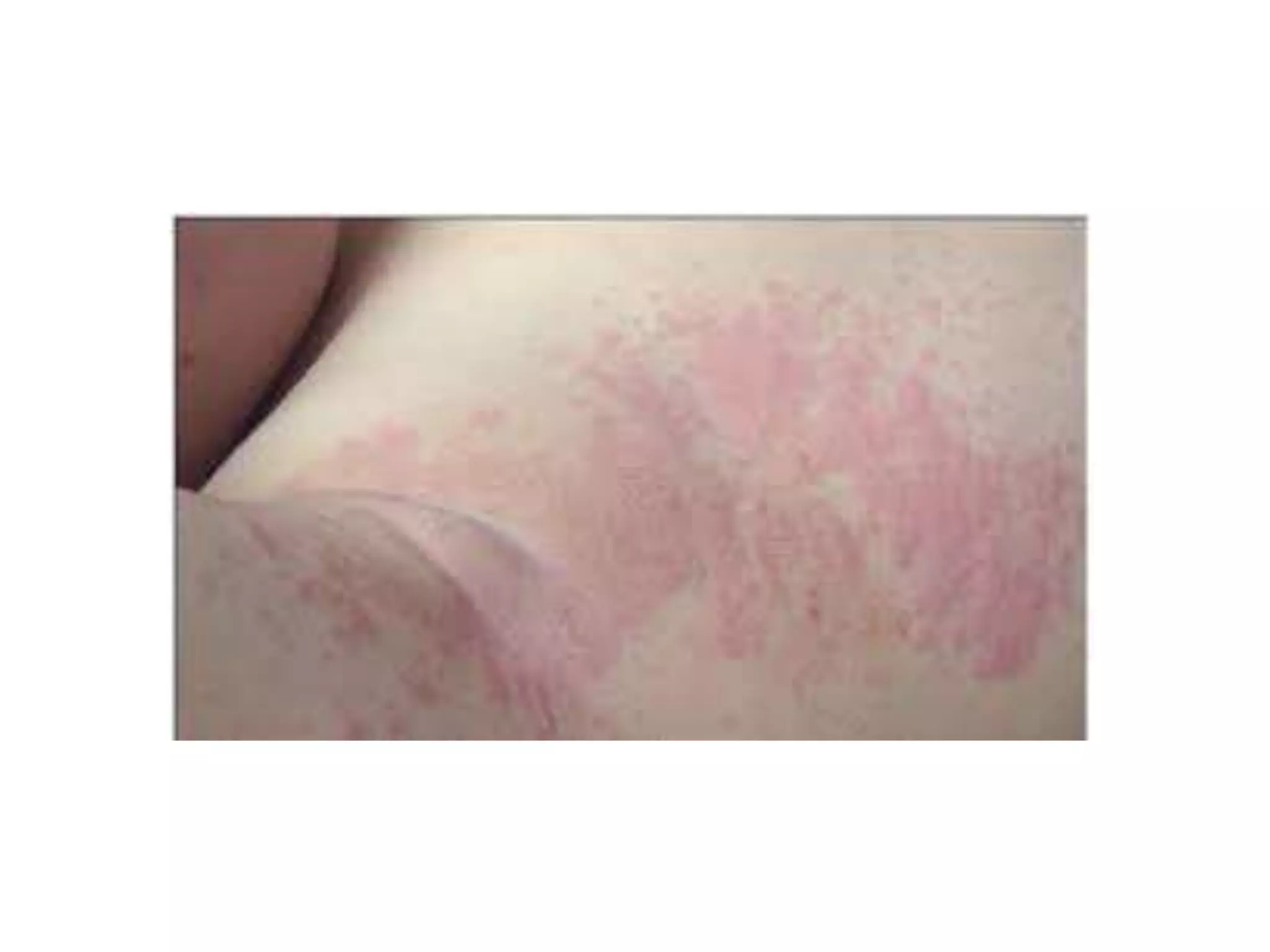 rashes - different types of rashes & diagnosis | PPTX
