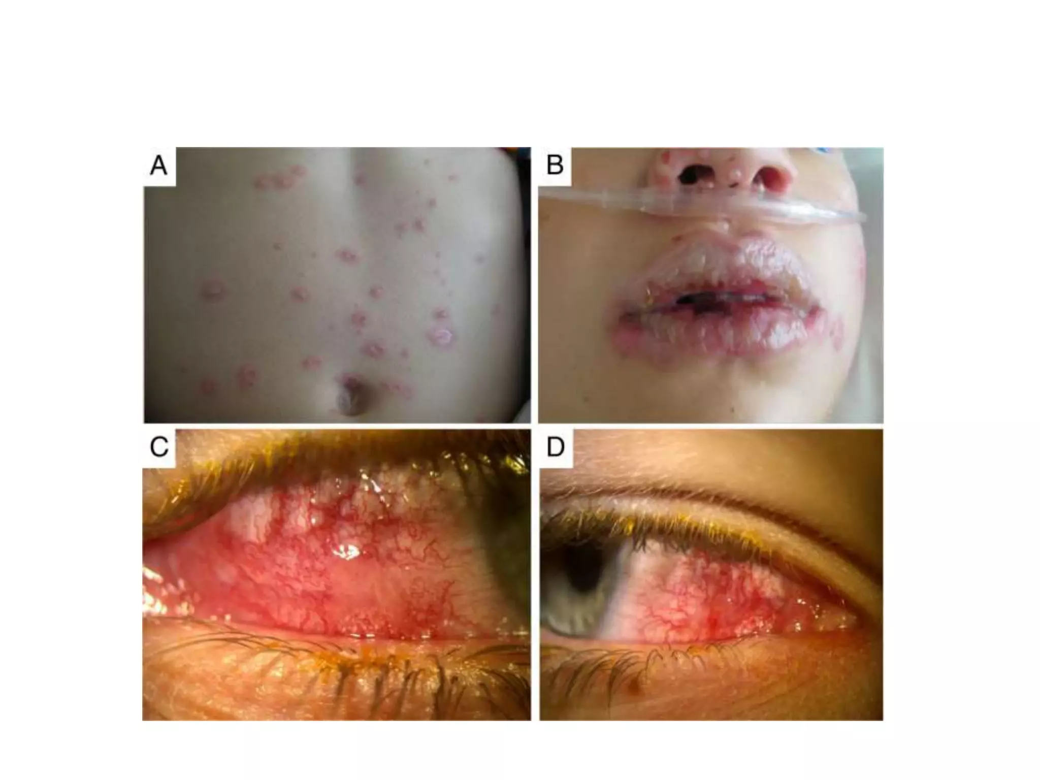 rashes - different types of rashes & diagnosis | PPTX