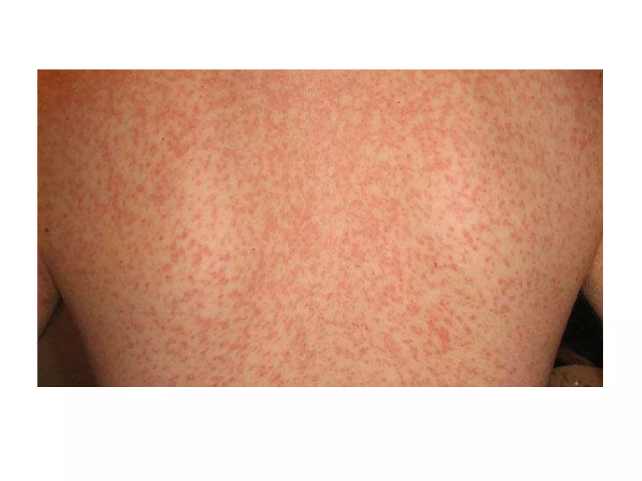 rashes - different types of rashes & diagnosis | PPTX