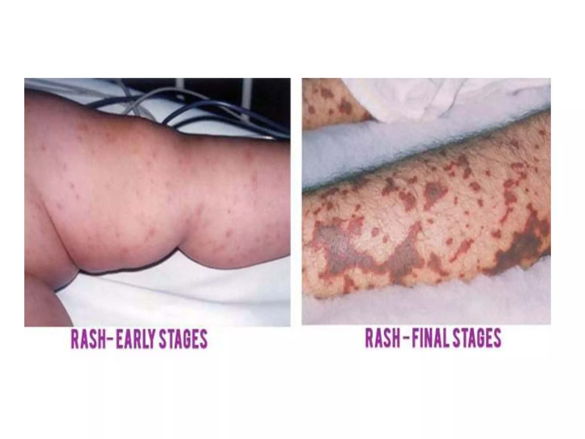 rashes - different types of rashes & diagnosis | PPTX