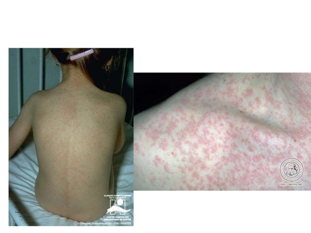 rashes - different types of rashes & diagnosis | PPTX | Infectious ...