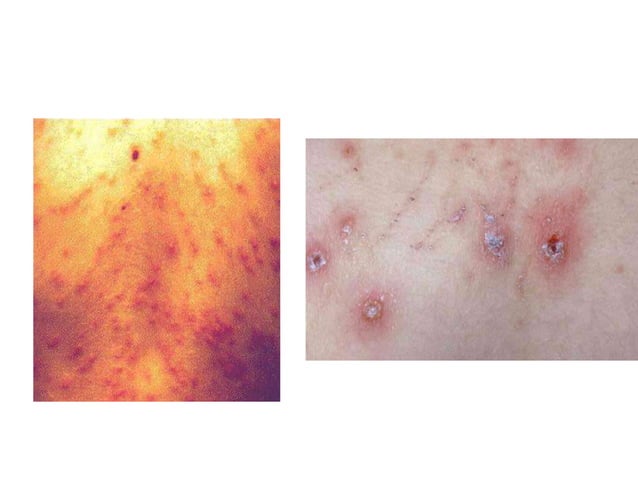 rashes - different types of rashes & diagnosis