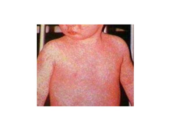 rashes - different types of rashes & diagnosis | PPTX | Infectious ...