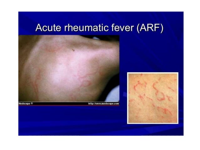 rashes - different types of rashes & diagnosis | PPTX | Infectious ...