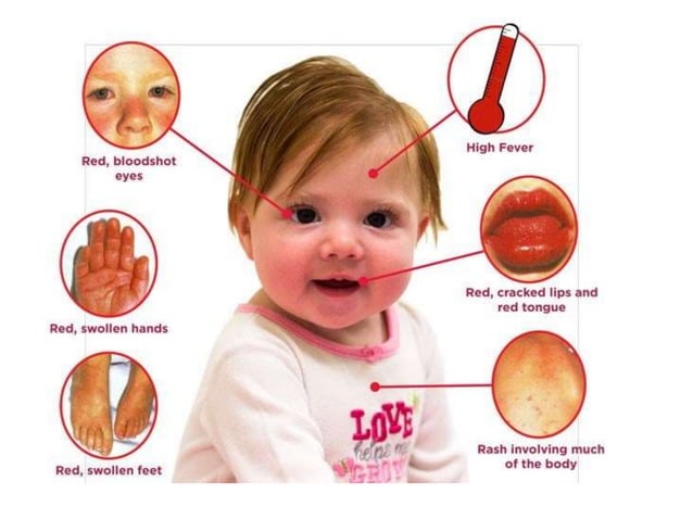 rashes - different types of rashes & diagnosis | PPTX | Infectious ...