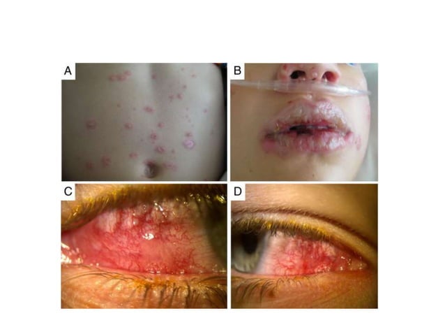 rashes - different types of rashes & diagnosis | PPTX | Infectious Diseases | Diseases and ...