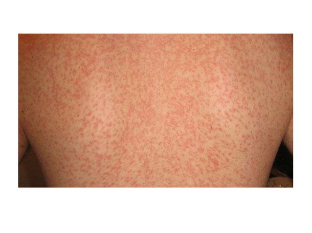 rashes - different types of rashes & diagnosis | PPTX | Infectious ...