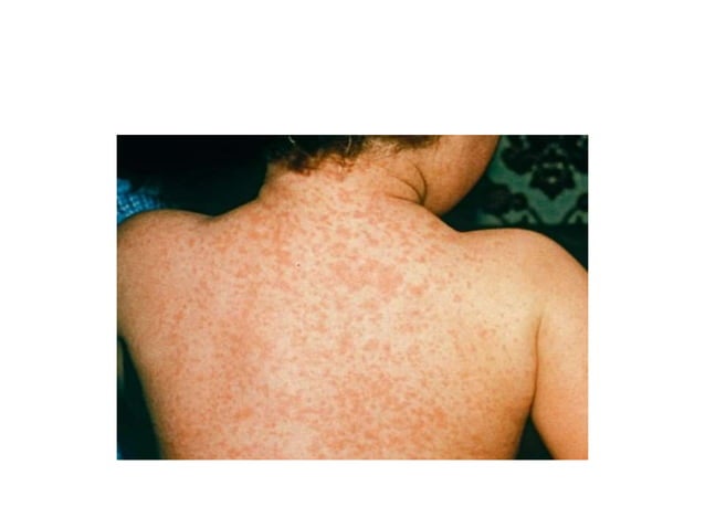 rashes - different types of rashes & diagnosis