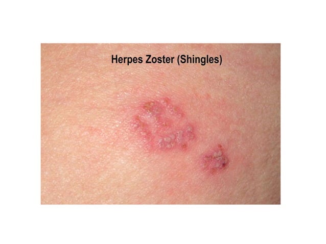 rashes - different types of rashes & diagnosis