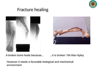 Zulfiqar Soomro 7 Fracture Healing – Primary & Secondary Bone Healing ...