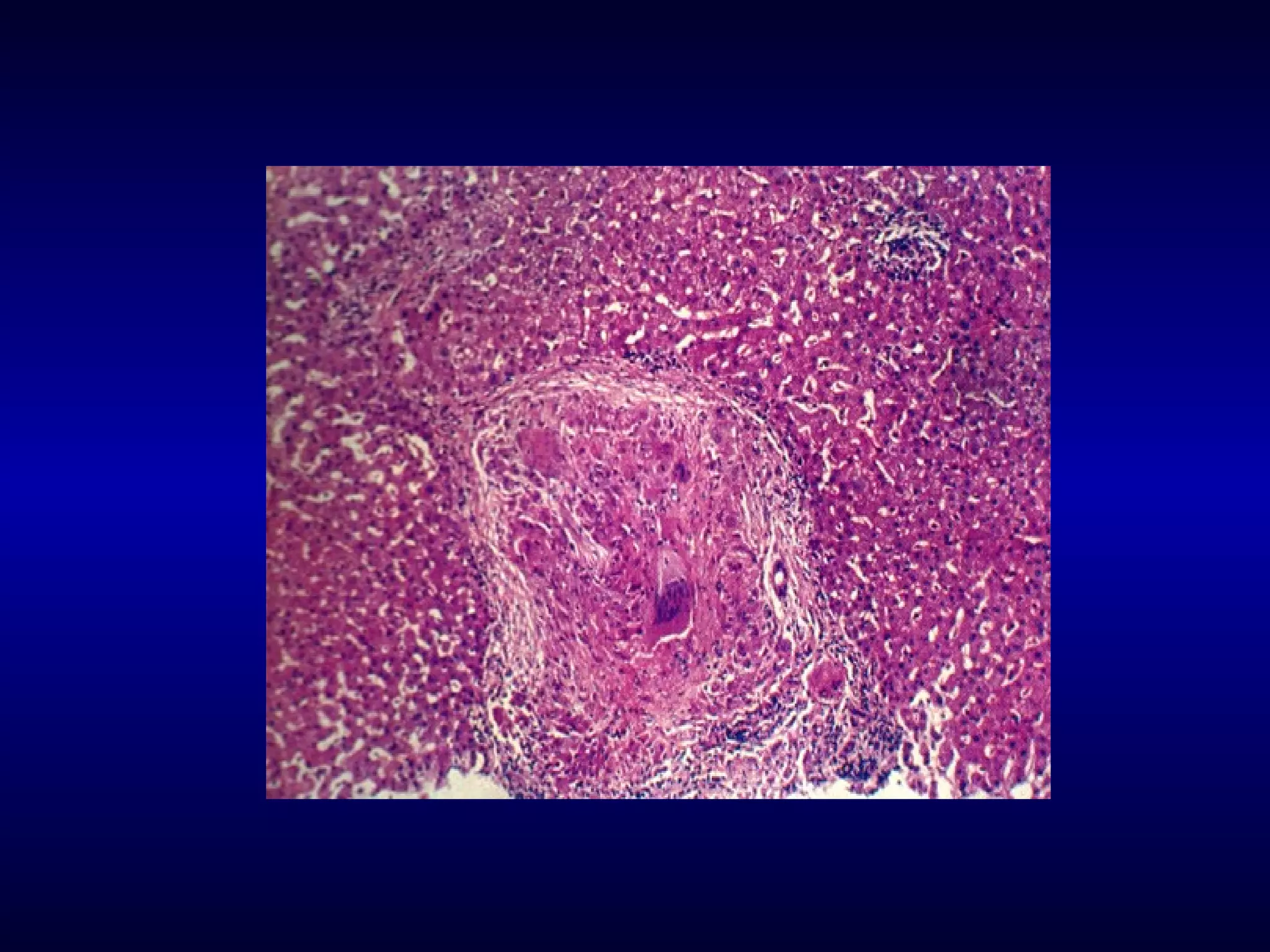 helminthic infection | PPT