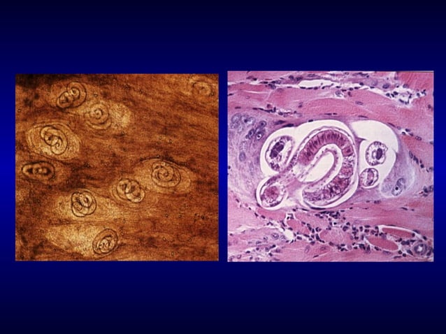 helminthic infection | PPT