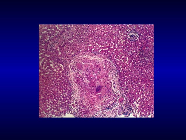 helminthic infection | PPT