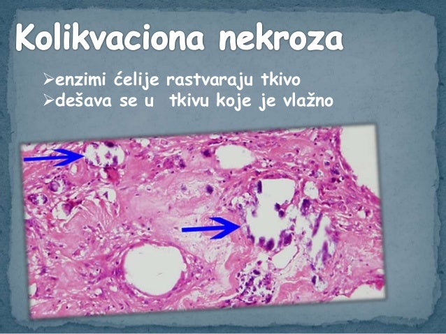 Patologija (nekroza)