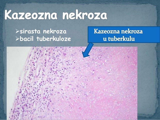 Patologija (nekroza)