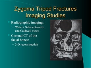 zygomatic bone fractures presentation.ppt