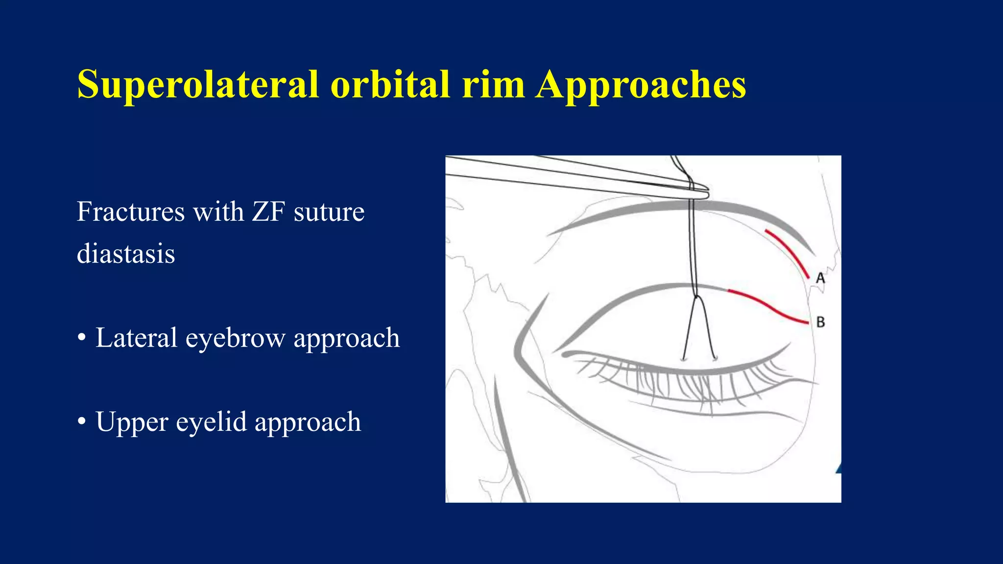 Zygoma fractures | PPTX