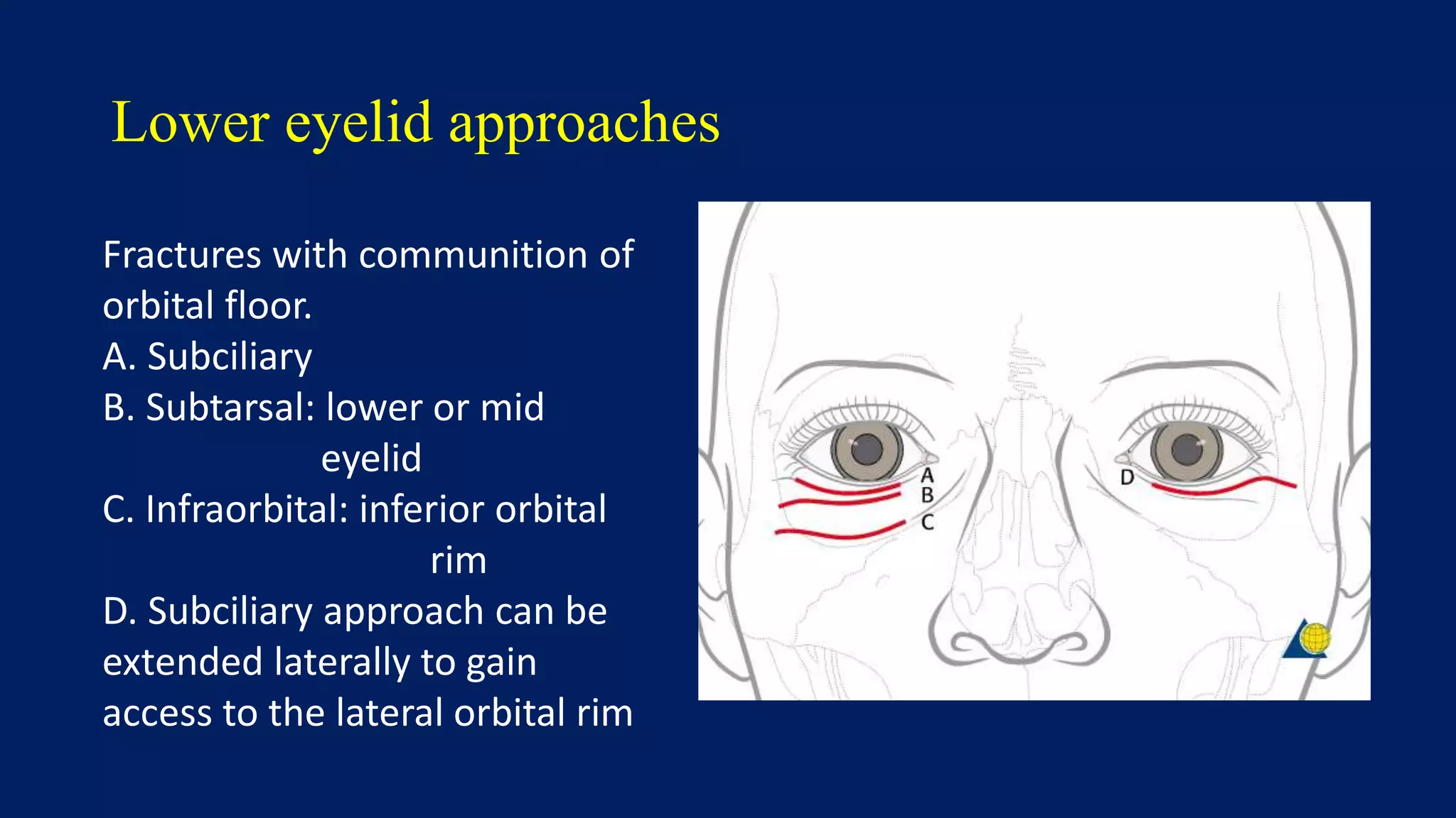Zygoma fractures | PPTX