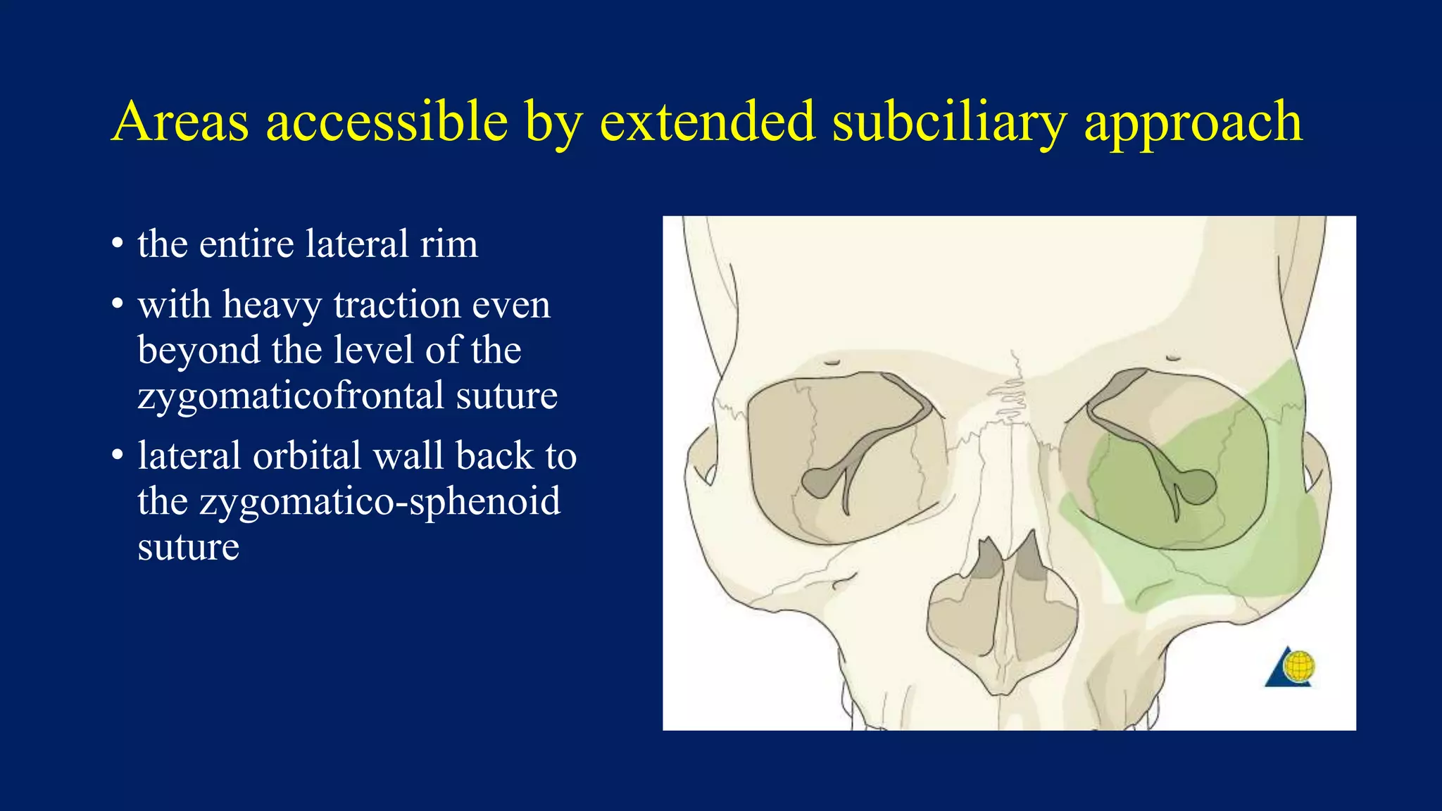 Zygoma fractures | PPTX