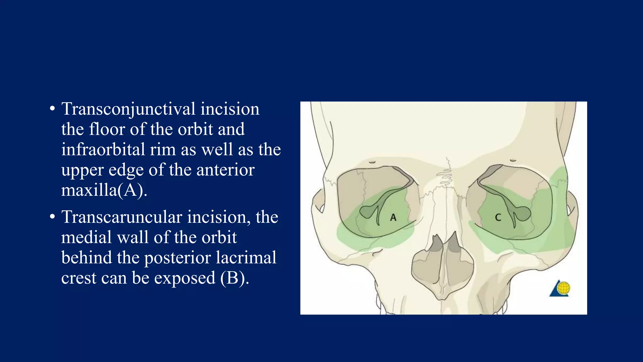 Zygoma fractures | PPTX