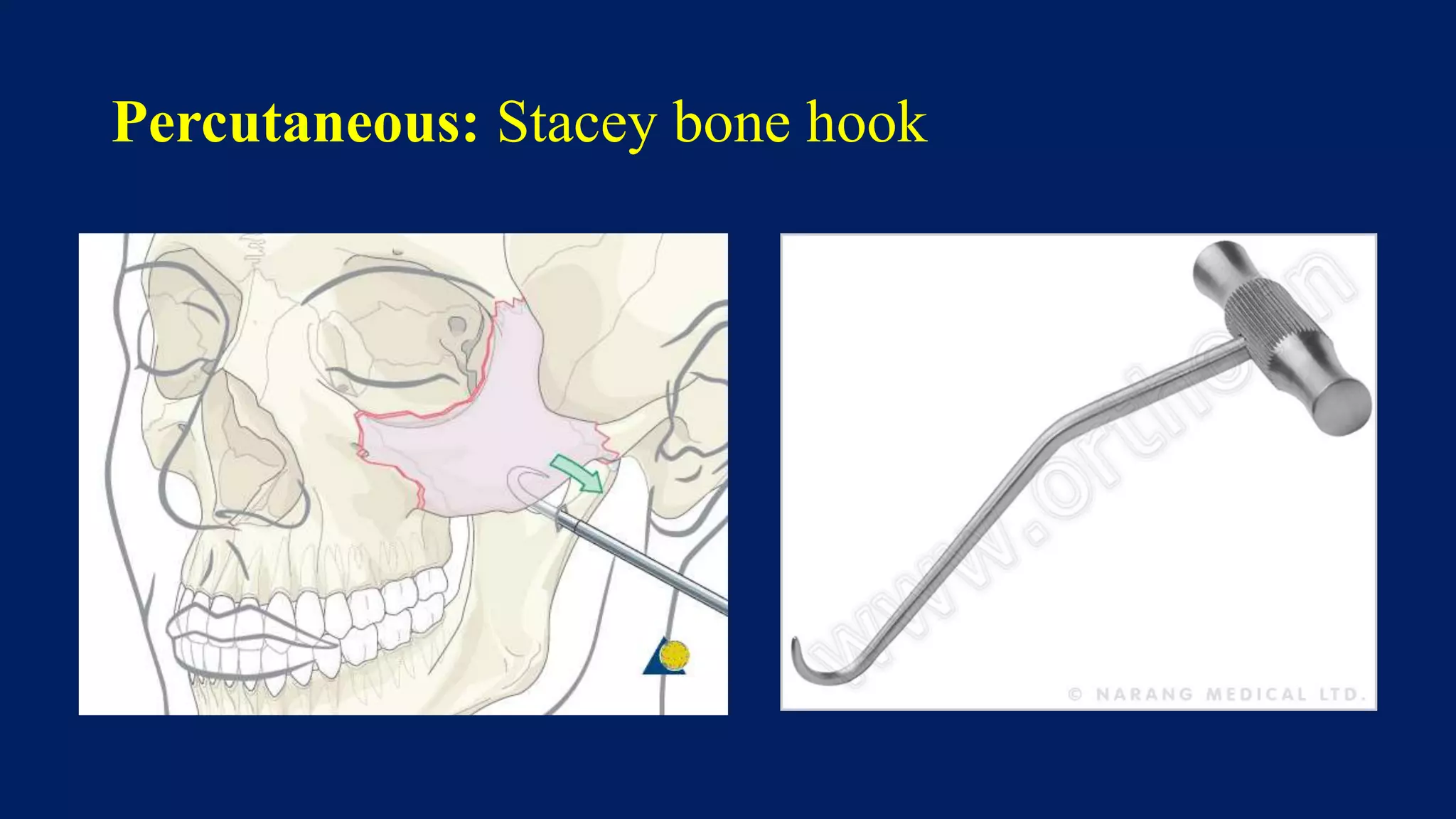 Zygoma fractures | PPTX