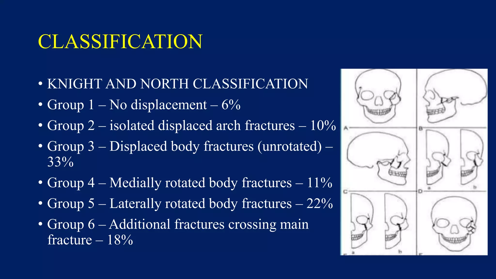 Zygoma fractures | PPTX