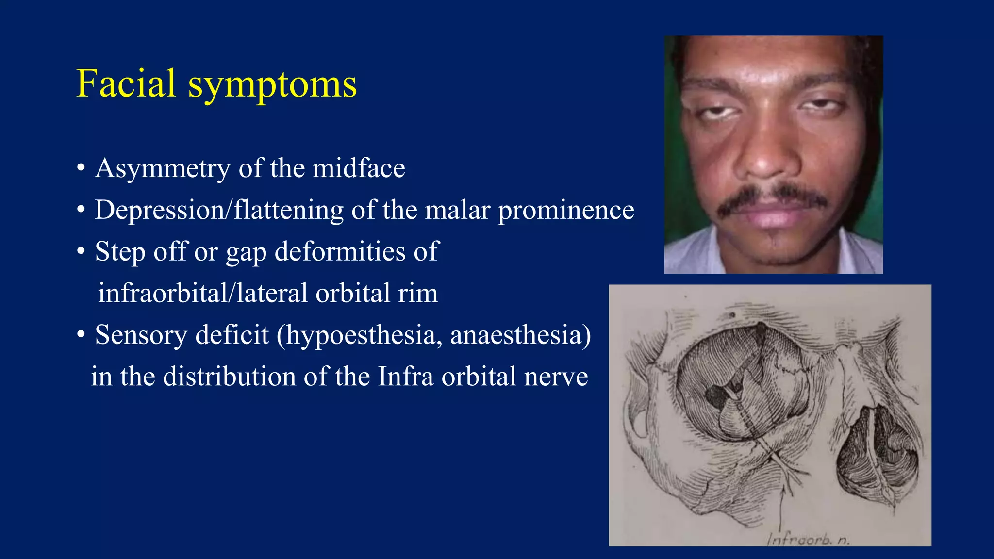 Zygoma fractures | PPTX