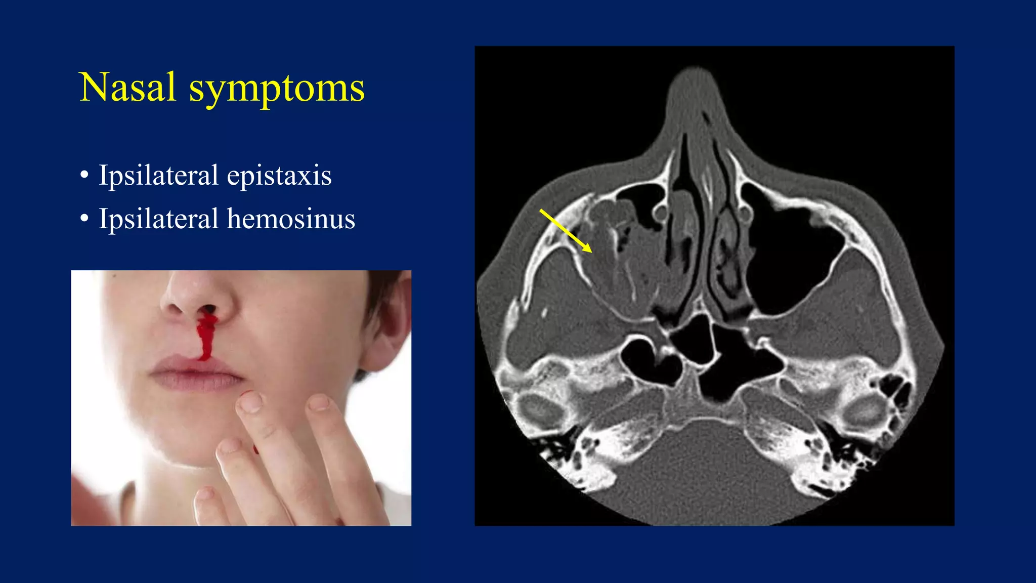 Zygoma fractures | PPTX