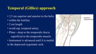 Zygoma fractures | PPTX