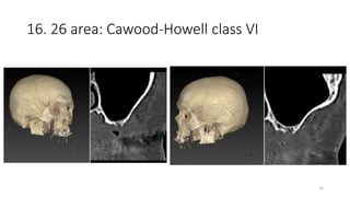 Zygoma implants Zygoma implants Zygoma implants | PPTX
