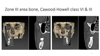 Zygoma implants Zygoma implants Zygoma implants | PPTX