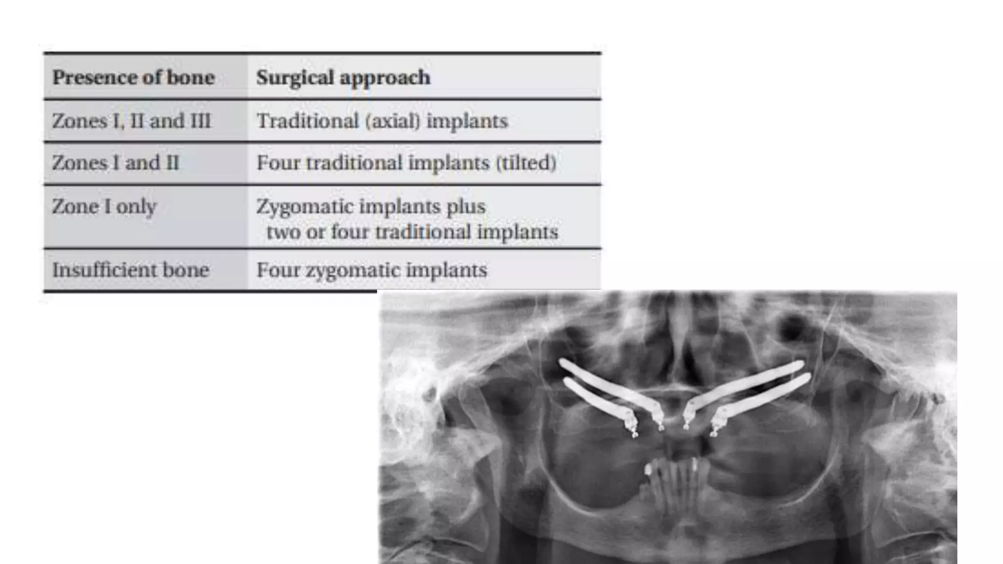 ZYGOMATIC AND PTERYGOID IMPLANTS.pptx