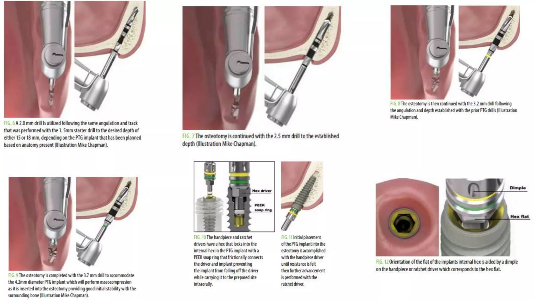 ZYGOMATIC AND PTERYGOID IMPLANTS.pptx