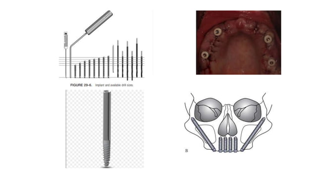 ZYGOMATIC AND PTERYGOID IMPLANTS.pptx