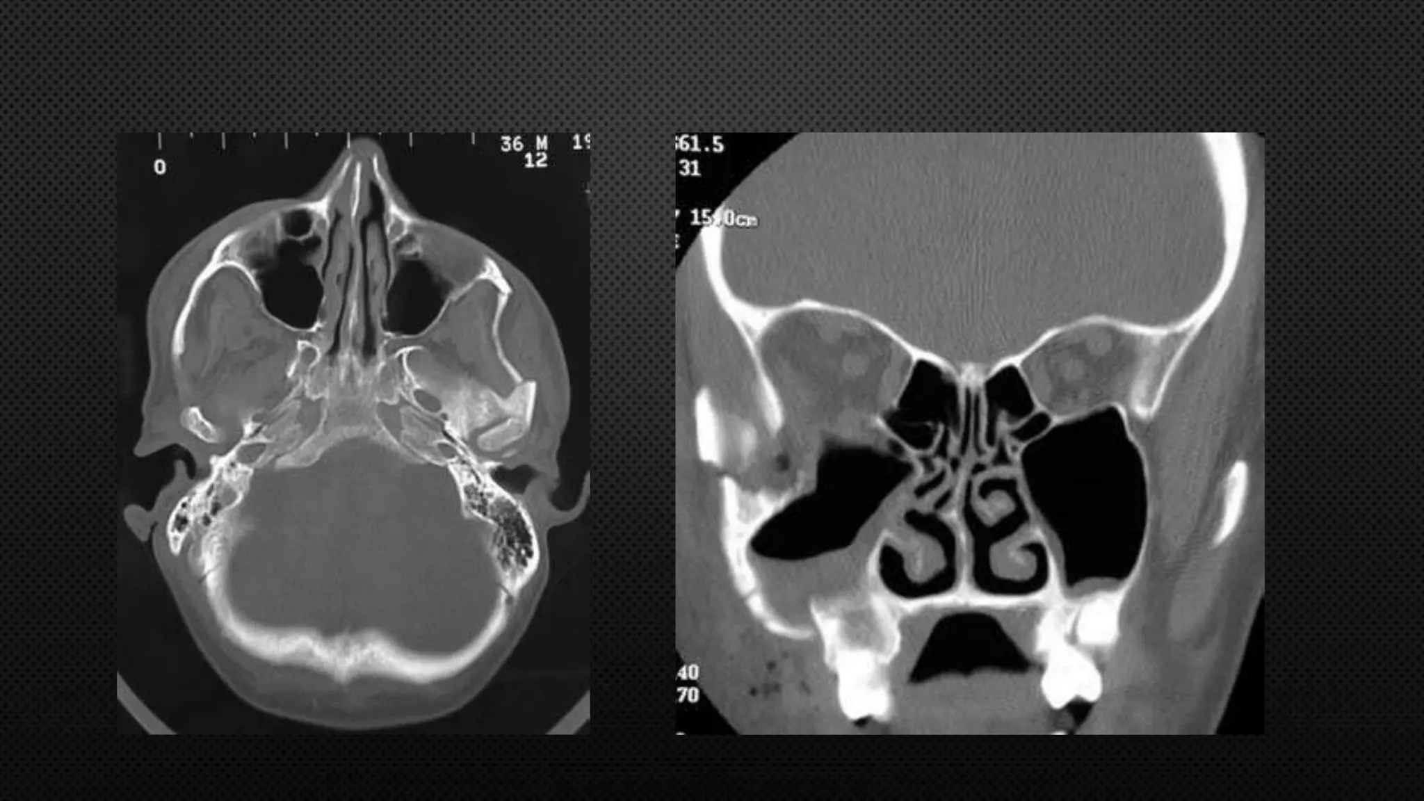 Zygomatic arch fracture | PPTX