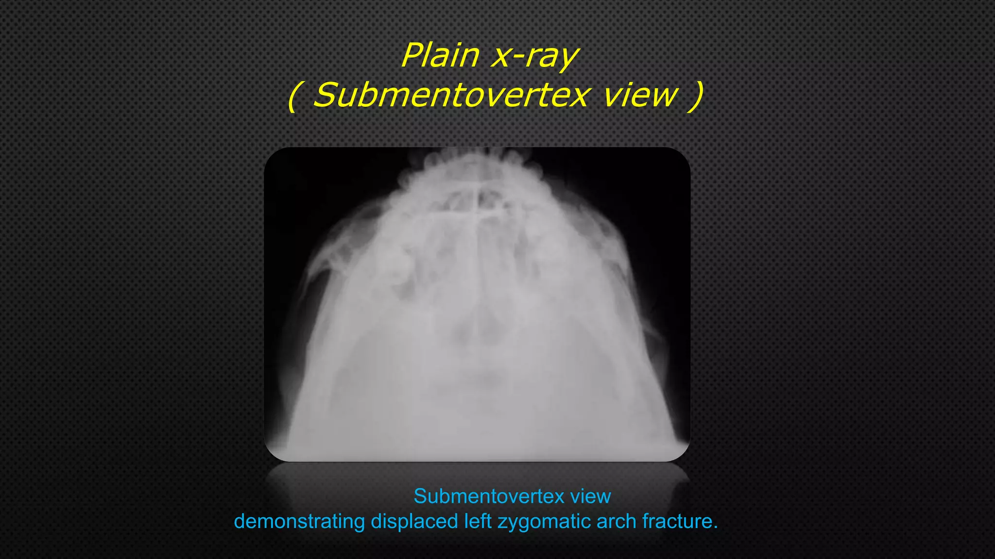Zygomatic arch fracture | PPTX