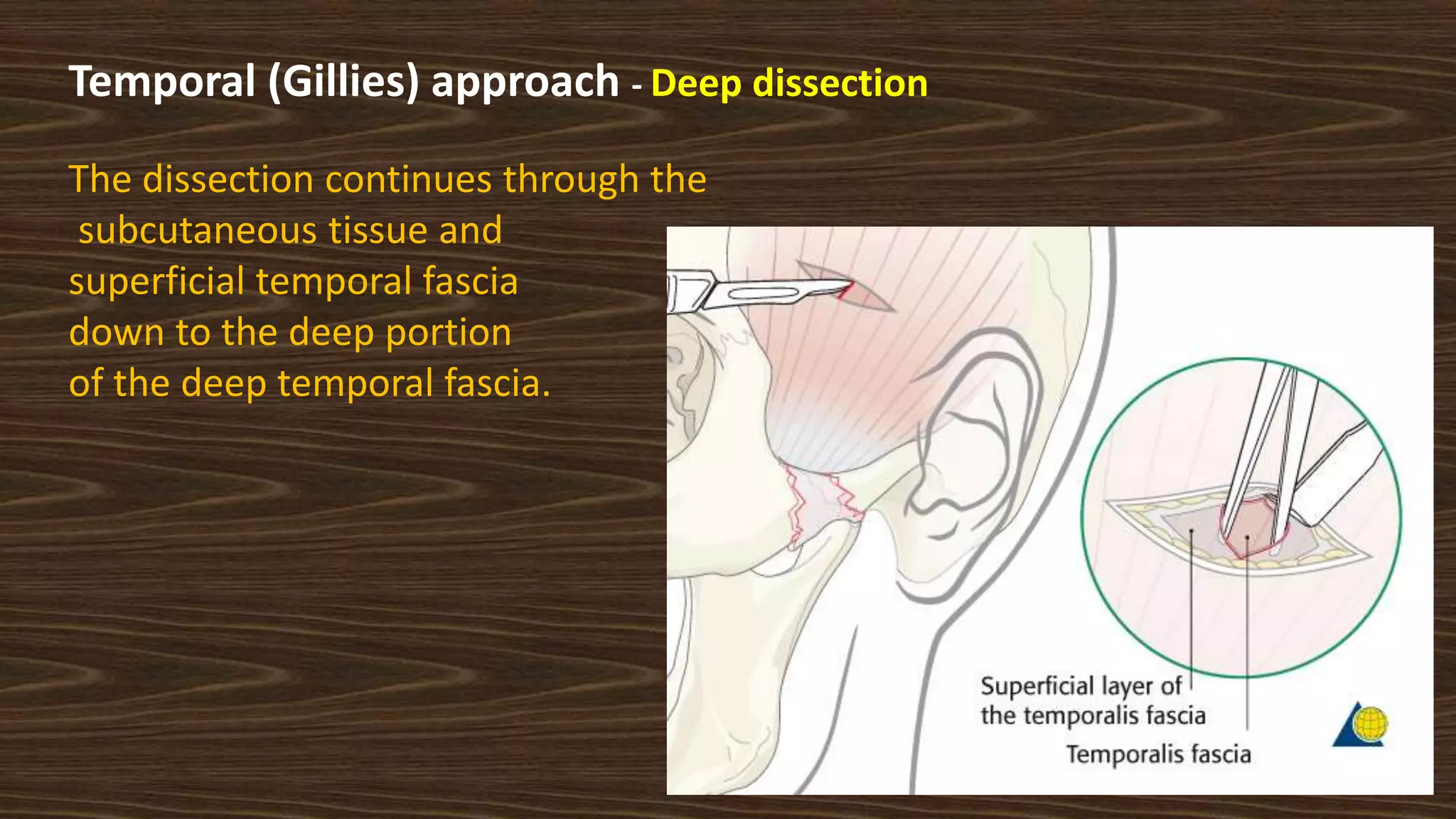 Zygomatic arch fracture | PPTX