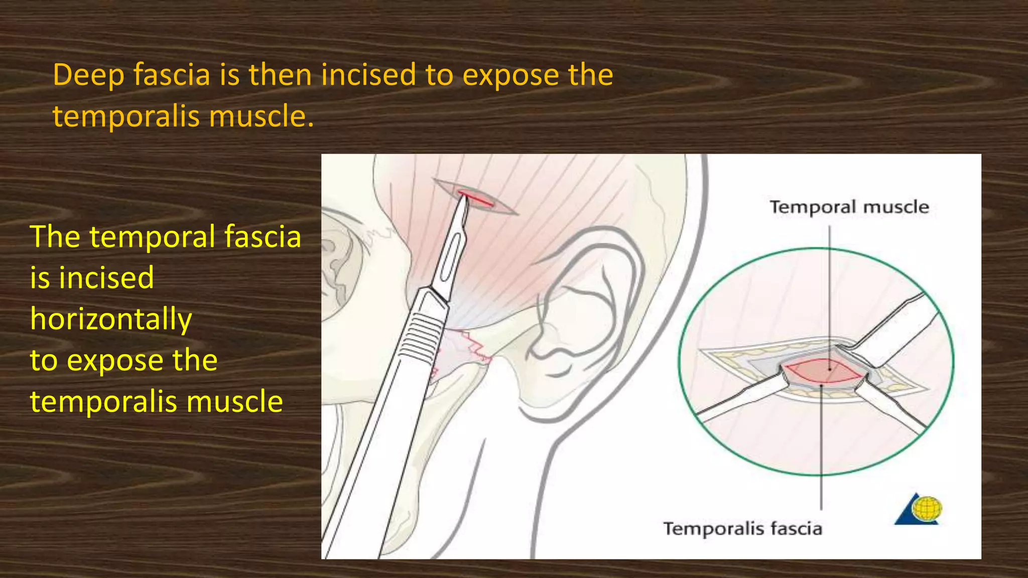 Zygomatic arch fracture | PPTX