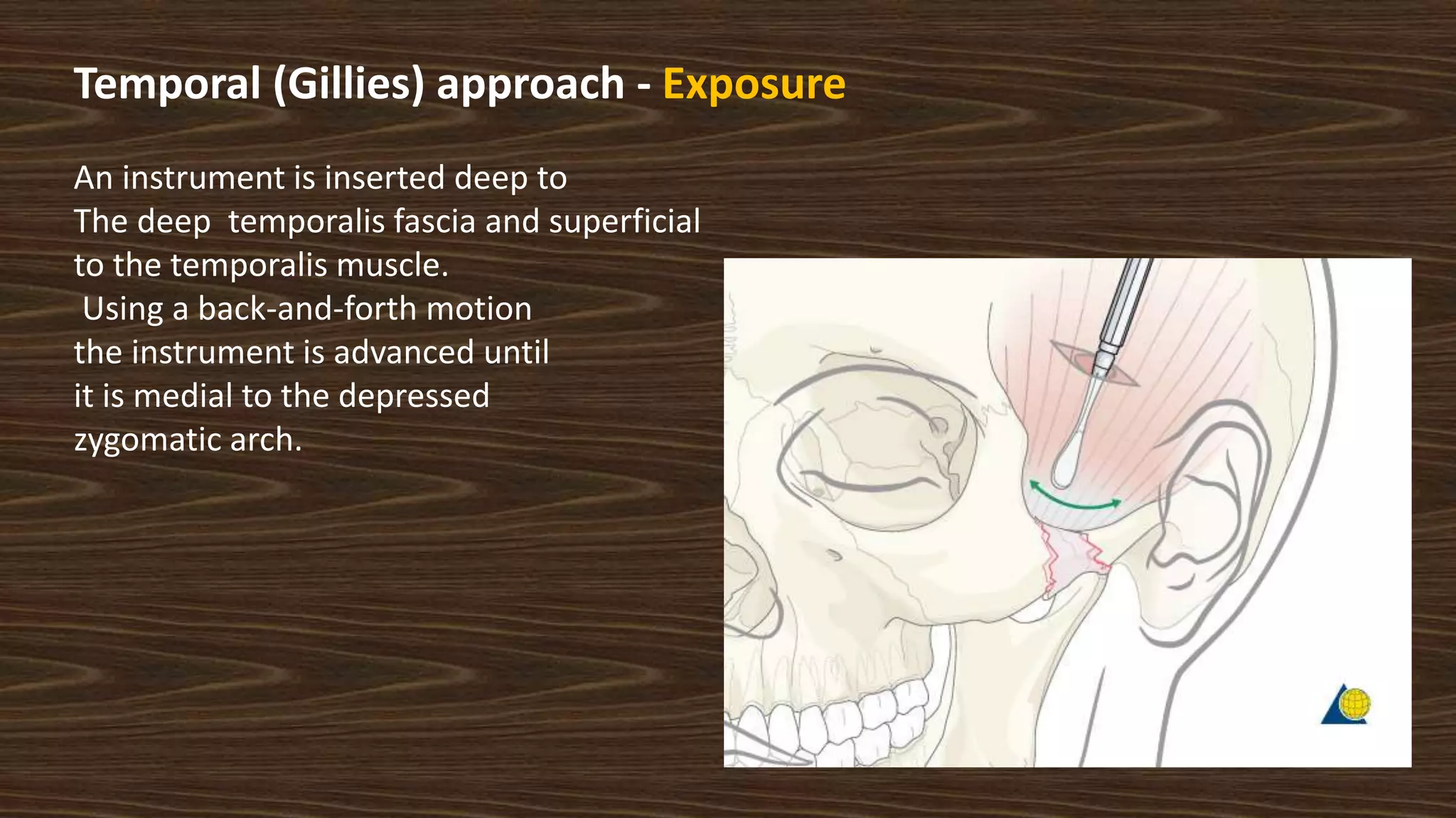 Zygomatic arch fracture | PPTX