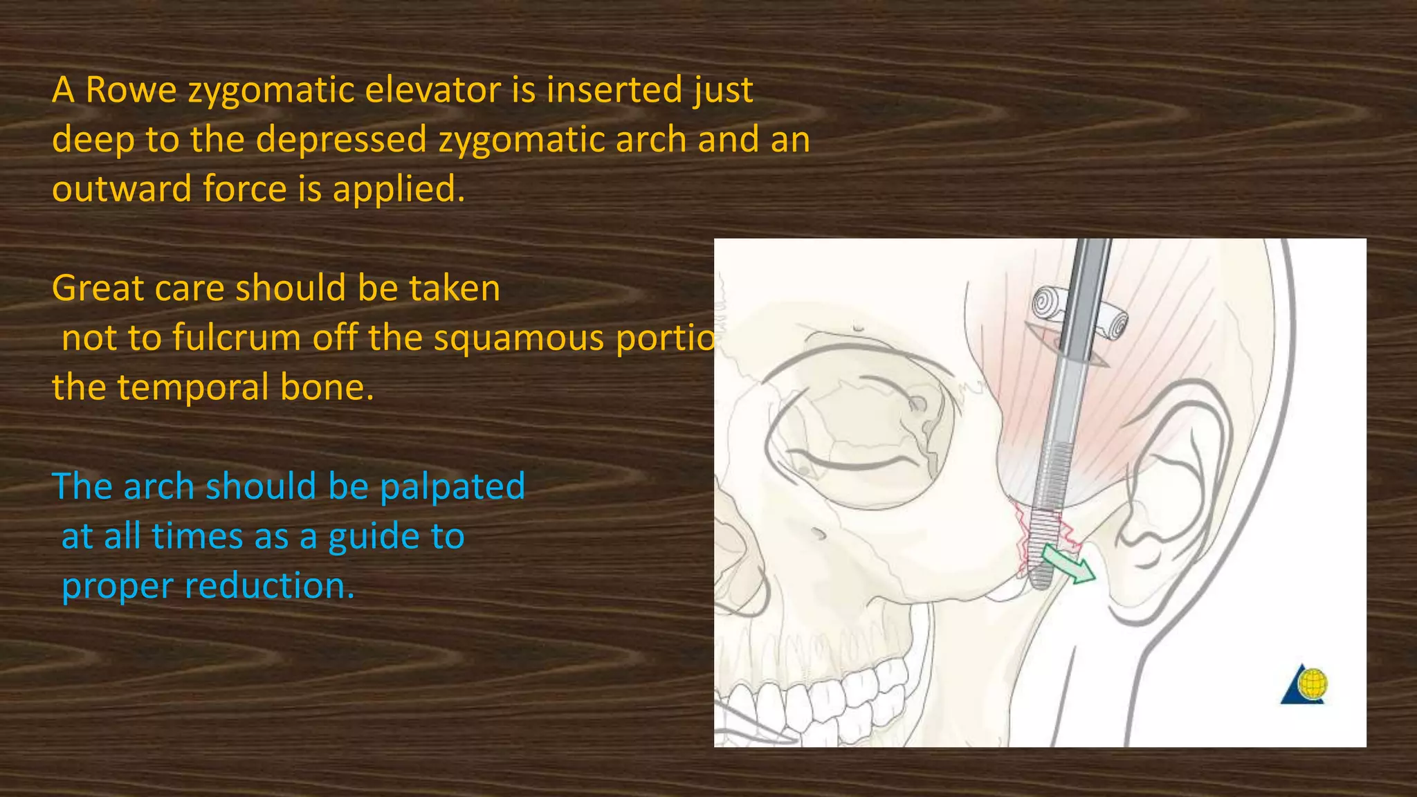 Zygomatic arch fracture | PPTX