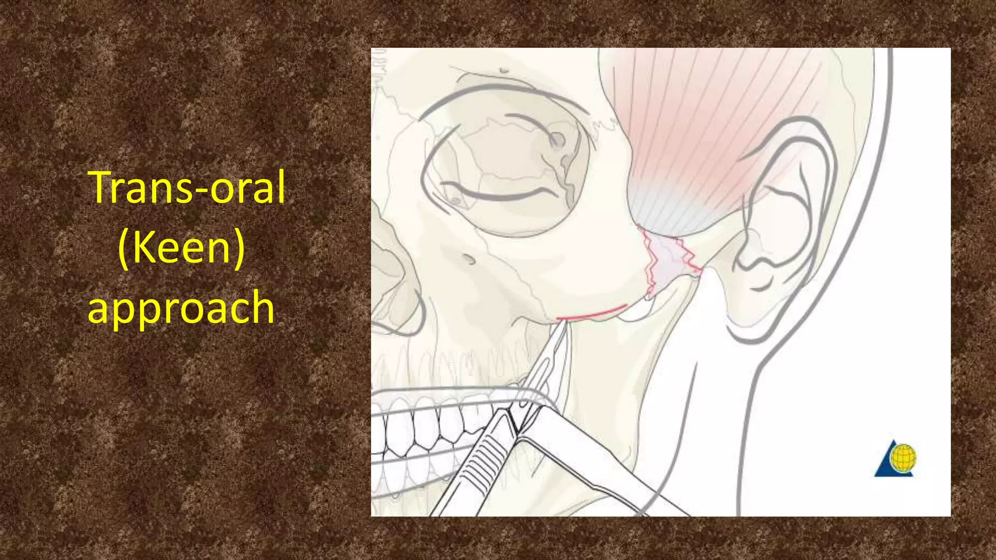Zygomatic arch fracture | PPTX