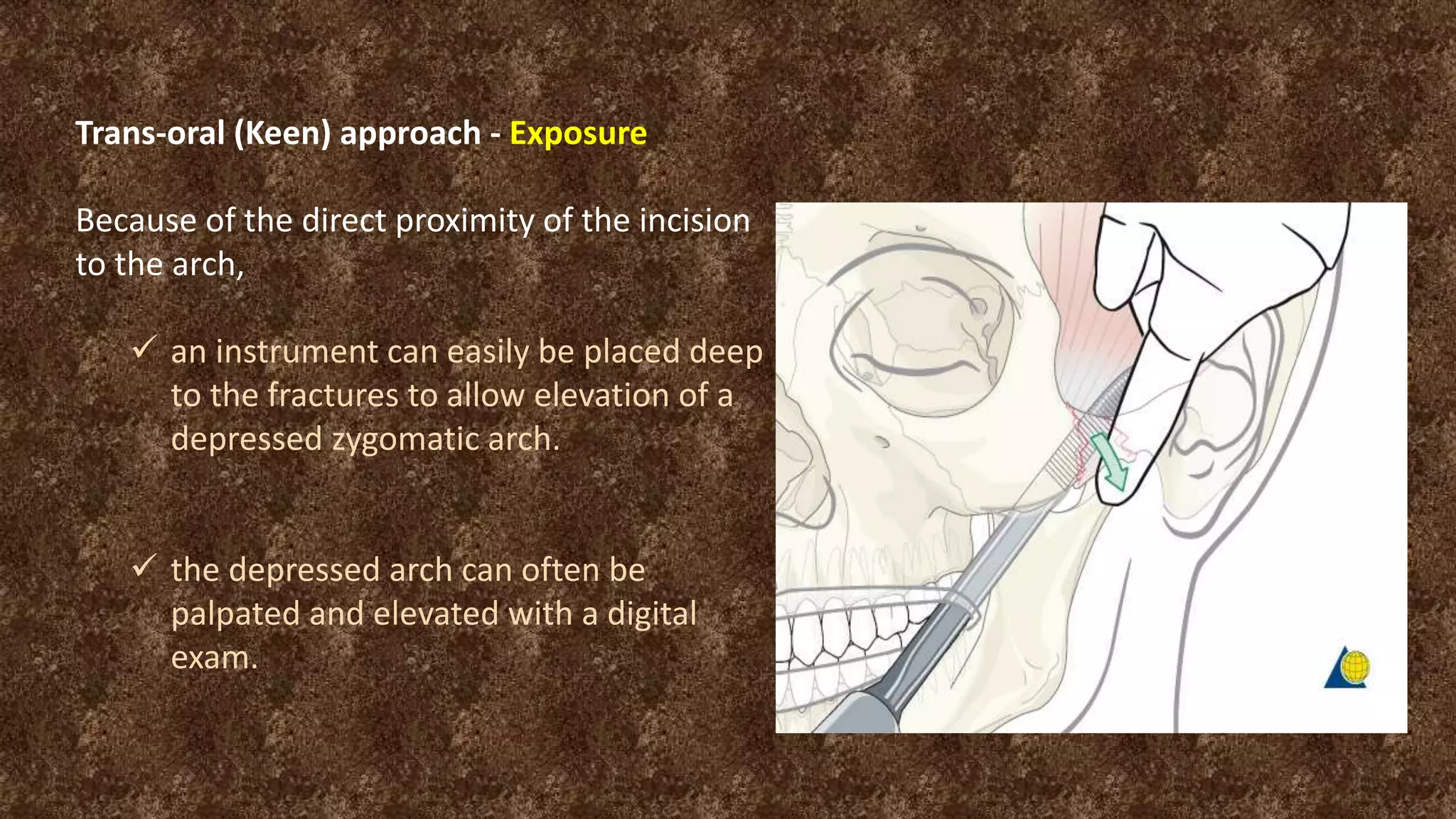 Zygomatic arch fracture | PPTX