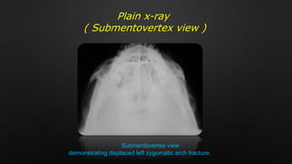 Zygomatic arch fracture | PPTX