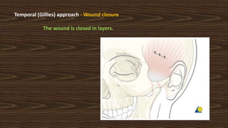 Zygomatic arch fracture | PPTX