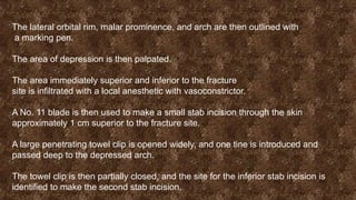 Zygomatic arch fracture | PPTX