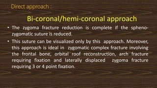 Zygomatic arch fracture | PPTX